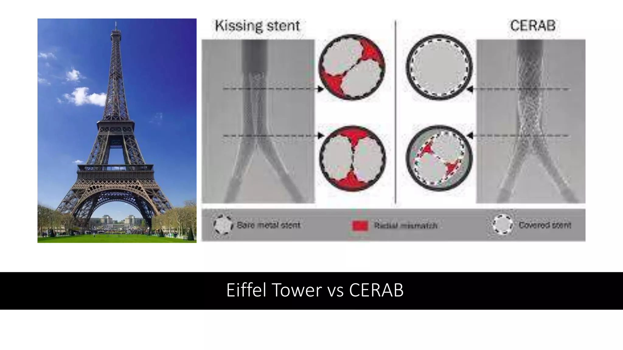 Neo innovation in Limb Ischemia Management | PPSX