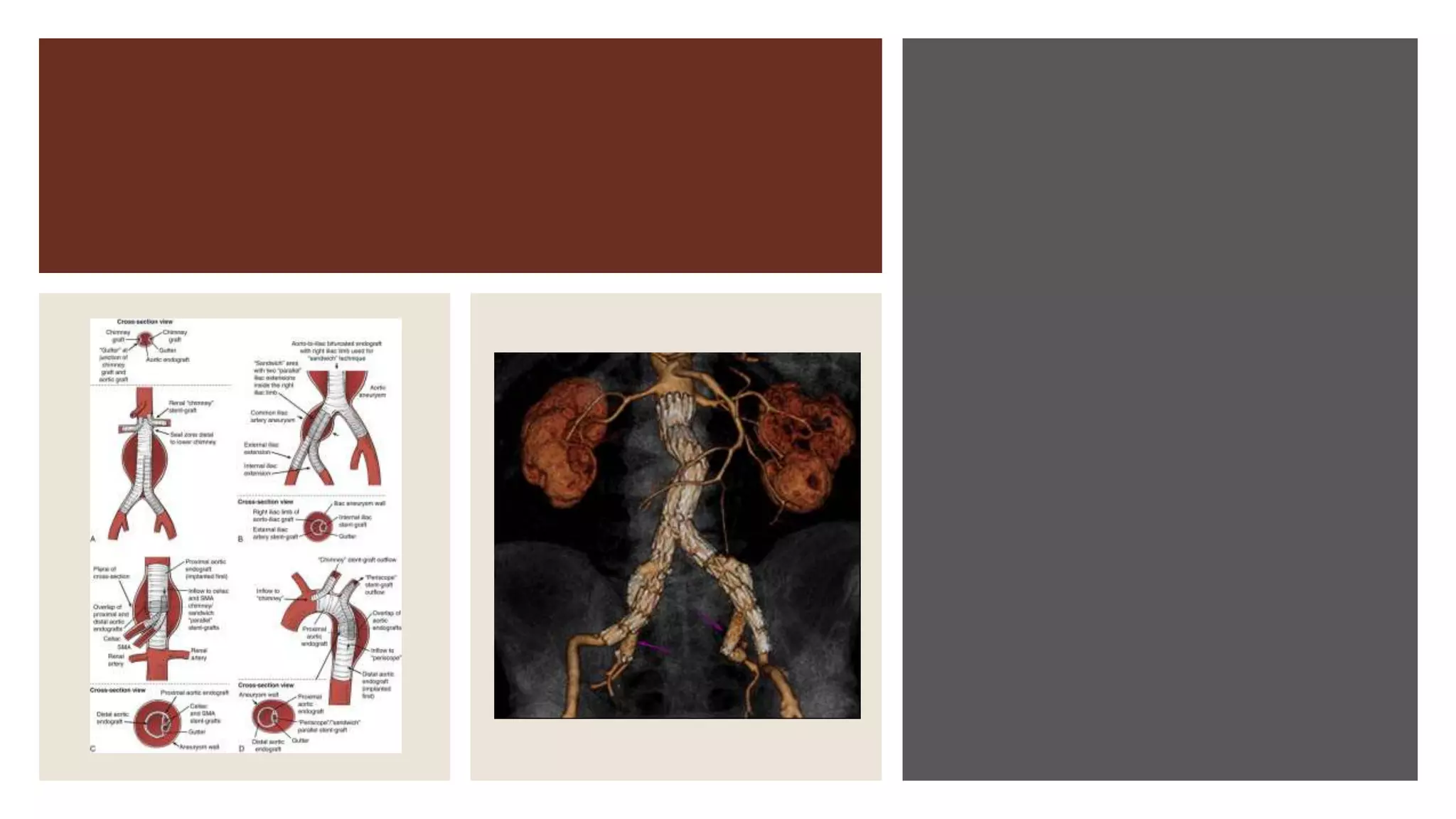 Neo innovation in Limb Ischemia Management | PPSX