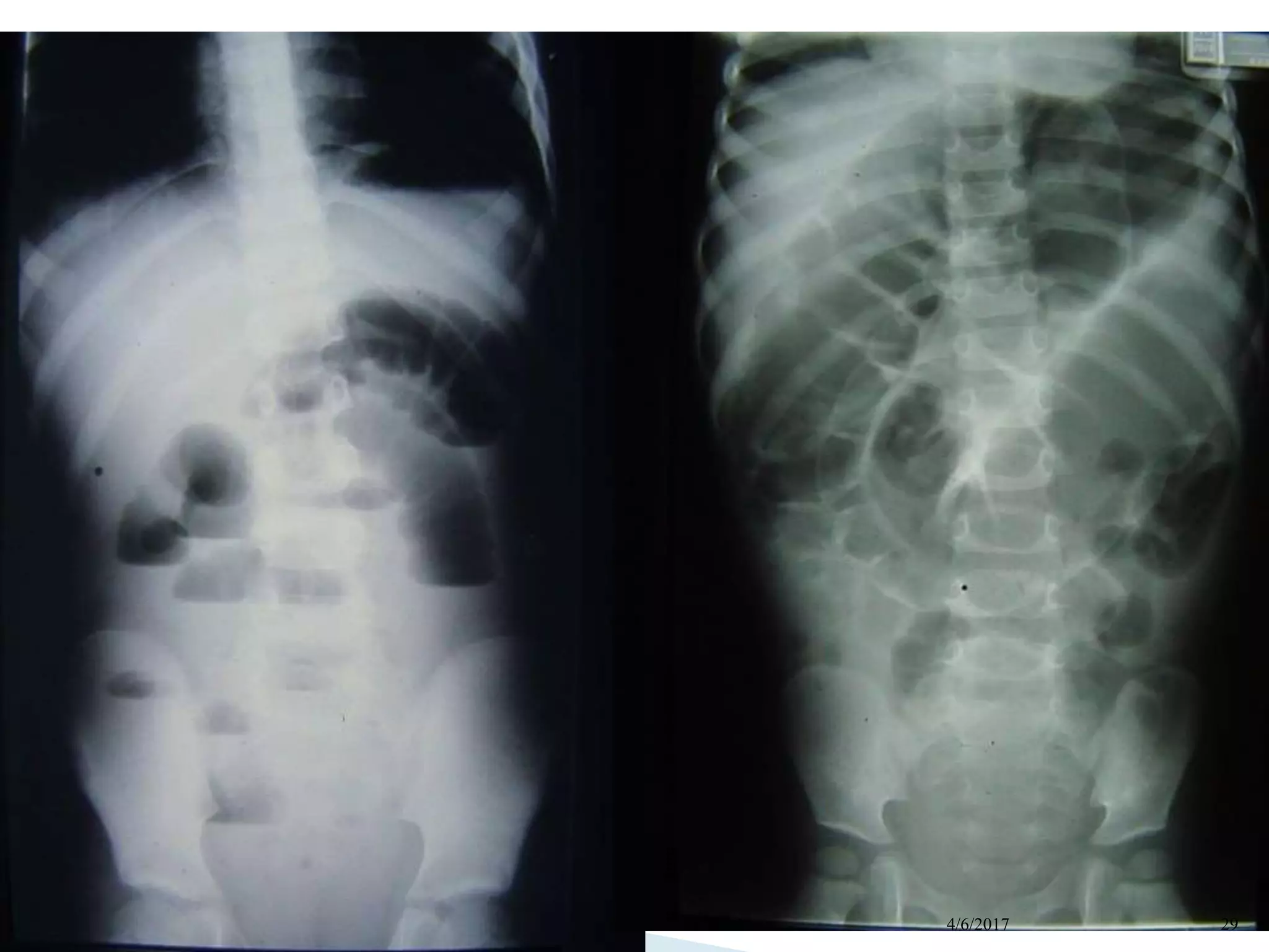 Neonatal intestinal obstruction | PPTX