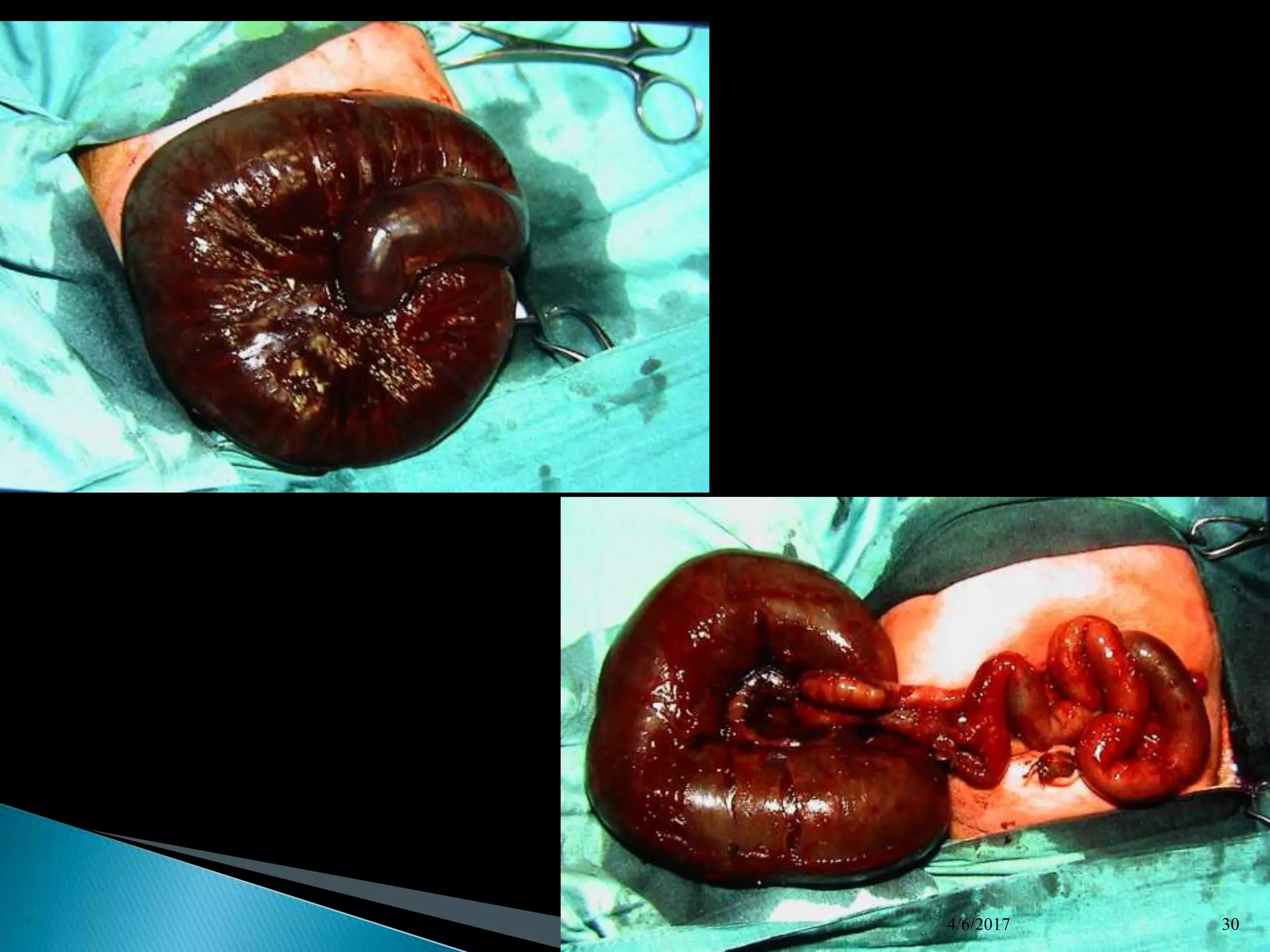Neonatal intestinal obstruction | PPTX