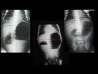 Neonatal intestinal obstruction | PPTX