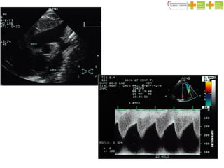 Neonatal coarc2 | PPT