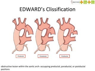 Neonatal coarc2 | PPT | Heart and Cardiovascular Diseases | Diseases ...