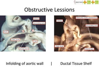 Neonatal coarc2 | PPT