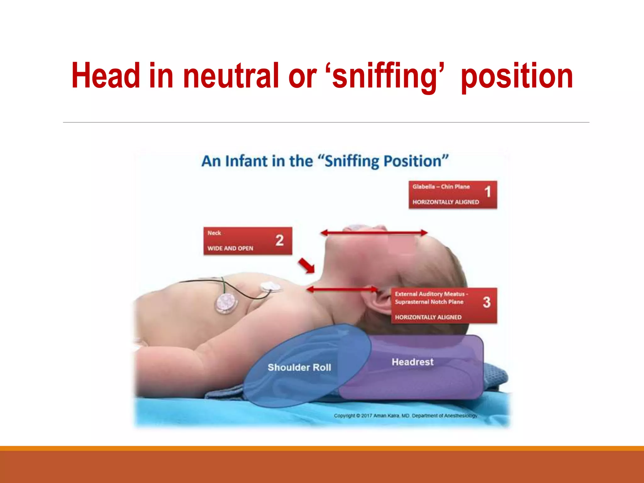 Neonatal resuscitation | PPT