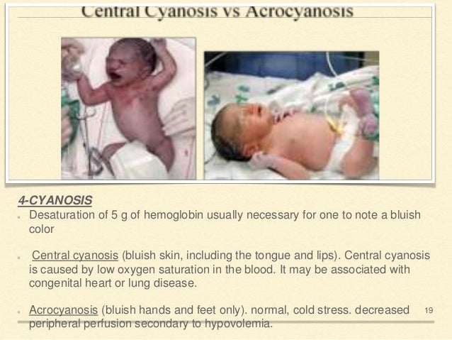 Neonatal examination
