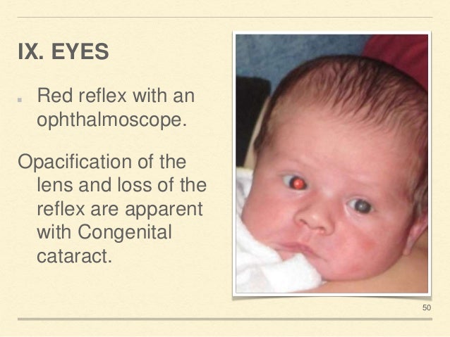 Red Reflex Ophthalmoscope