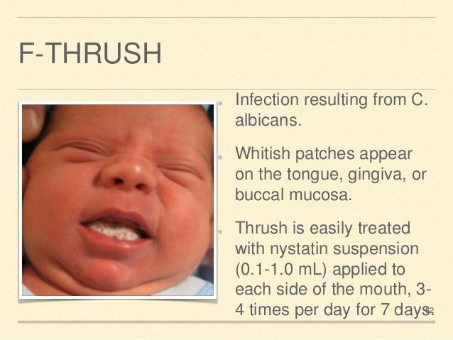 Thrush Buccal Mucosa
