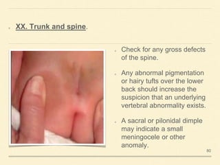 Benign Sacral Dimple