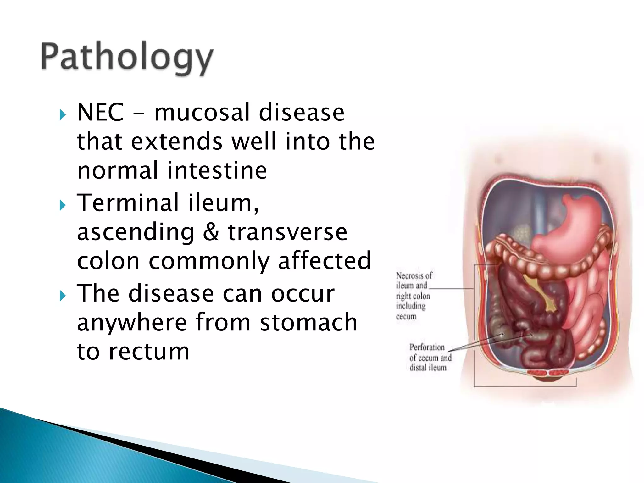Neonatal acute abdomen. 7th yr | PPTX