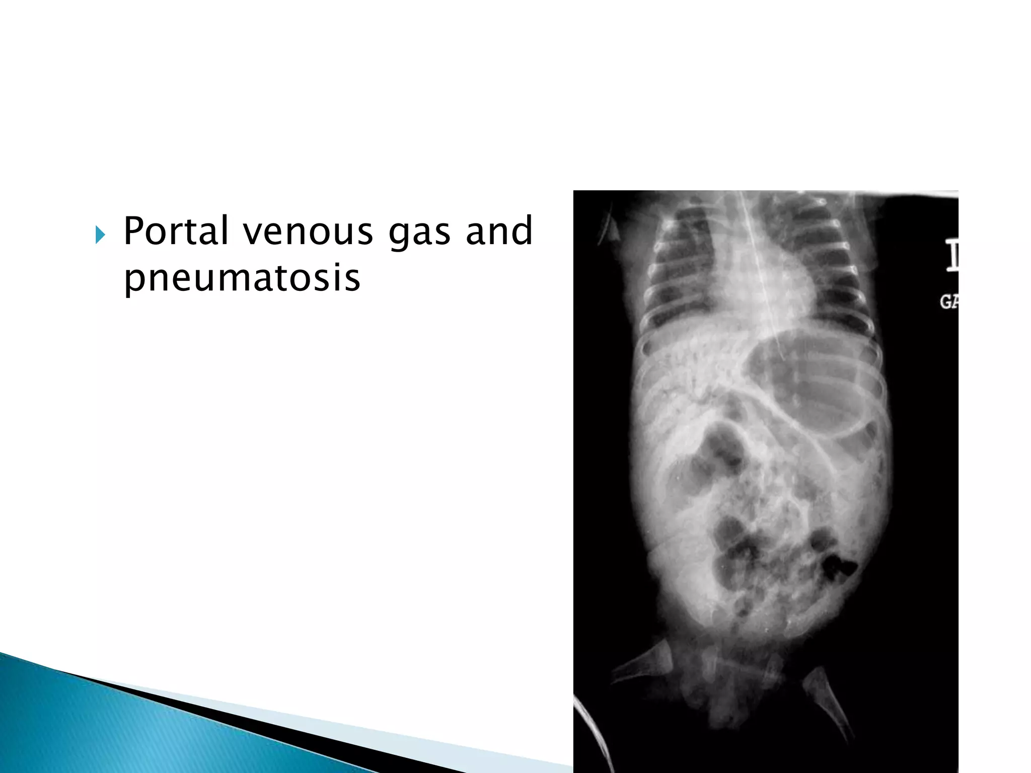 Neonatal acute abdomen. 7th yr | PPTX
