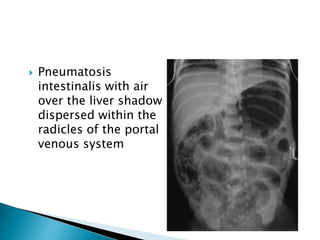 Neonatal acute abdomen. 7th yr | PPTX | Digestive Disorders | Diseases ...