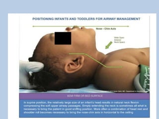 Neonatal and paediatric anaesthesia | PPTX