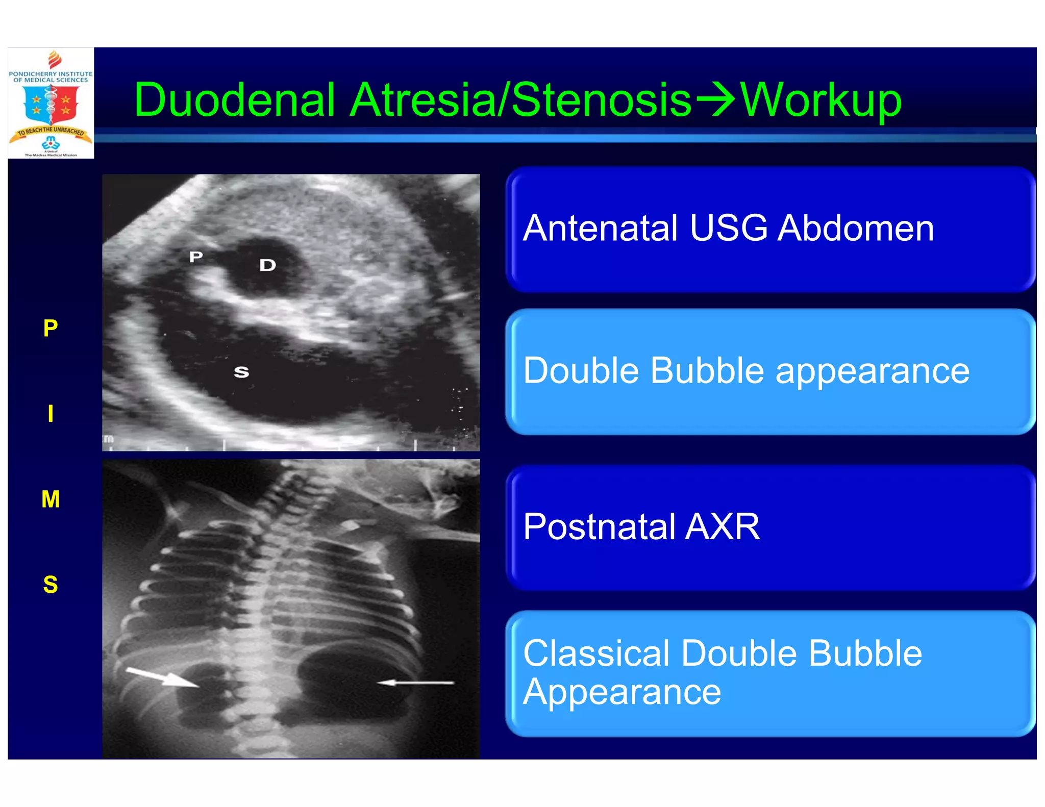 Neonatal biliary emesis- a problem based approach | PDF