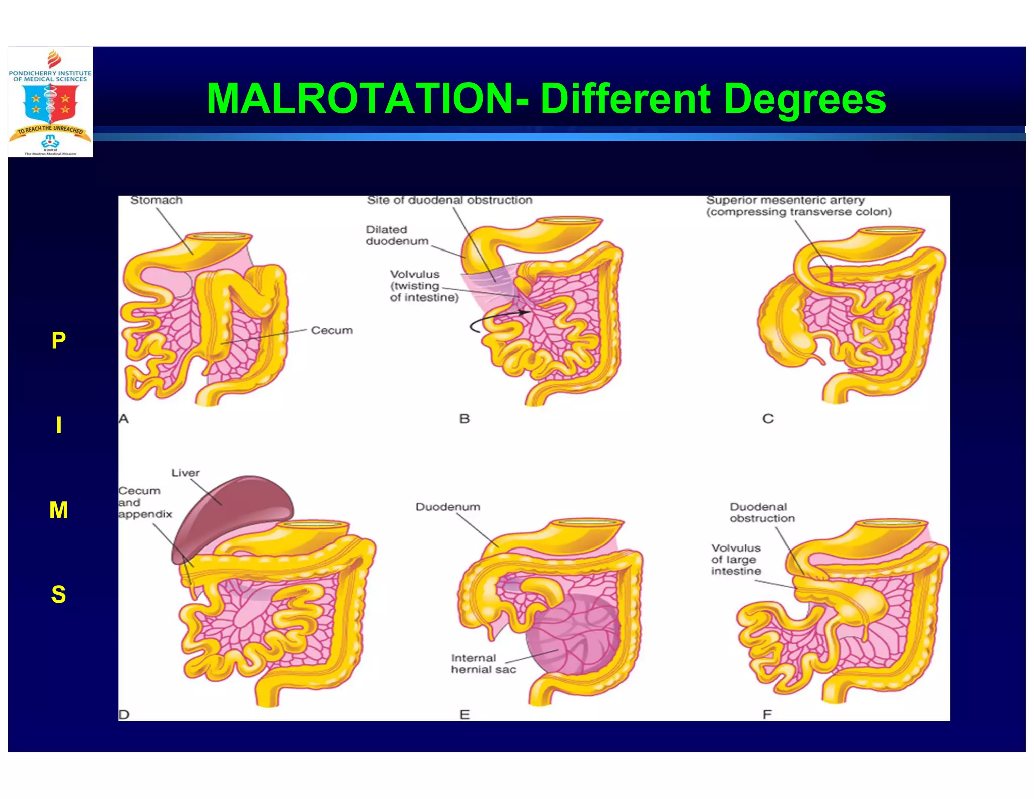 Neonatal biliary emesis- a problem based approach | PDF