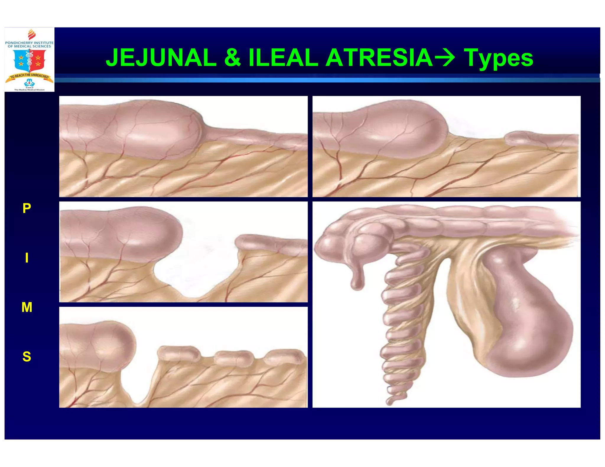 Neonatal biliary emesis- a problem based approach | PPT