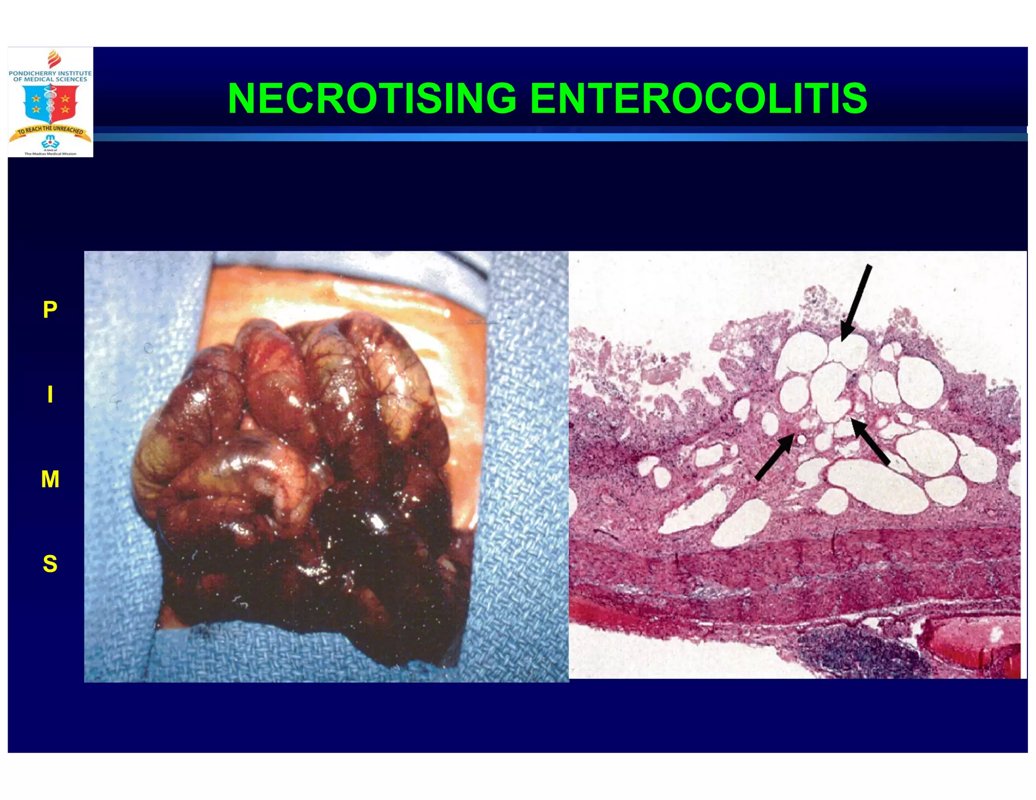 Neonatal biliary emesis- a problem based approach | PPT