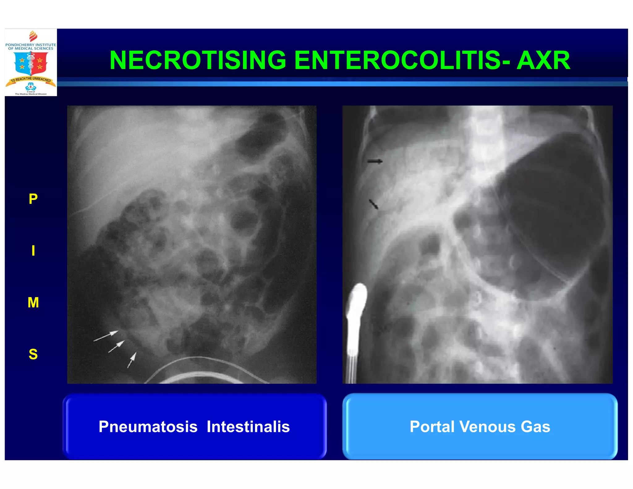 Neonatal biliary emesis- a problem based approach | PPT