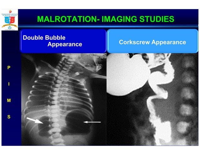 Neonatal biliary emesis- a problem based approach | PPT