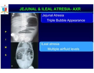 Neonatal biliary emesis- a problem based approach | PDF