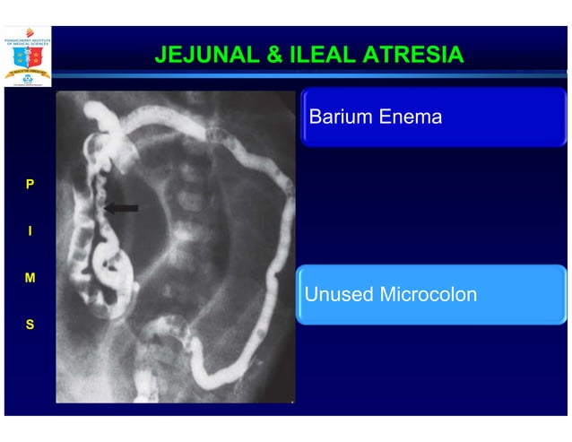 Neonatal biliary emesis- a problem based approach | PPT