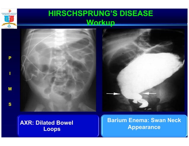 Neonatal biliary emesis- a problem based approach | PPT