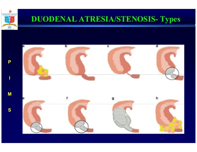 Neonatal biliary emesis- a problem based approach