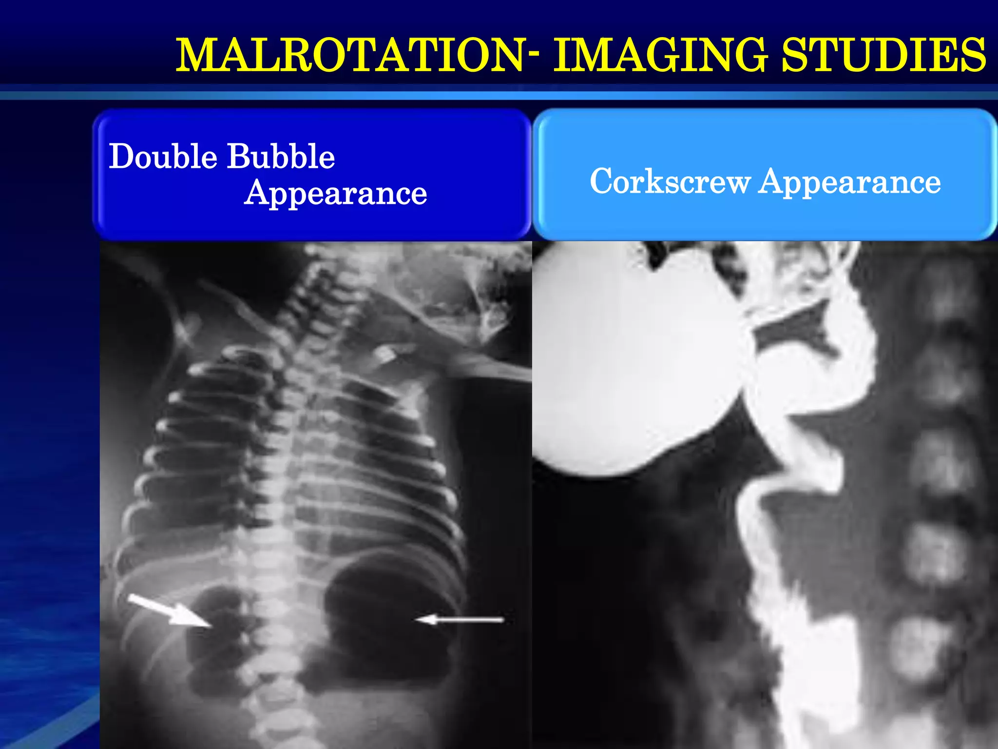 Neonatal Bilious Vomiting- part1 | PPTX