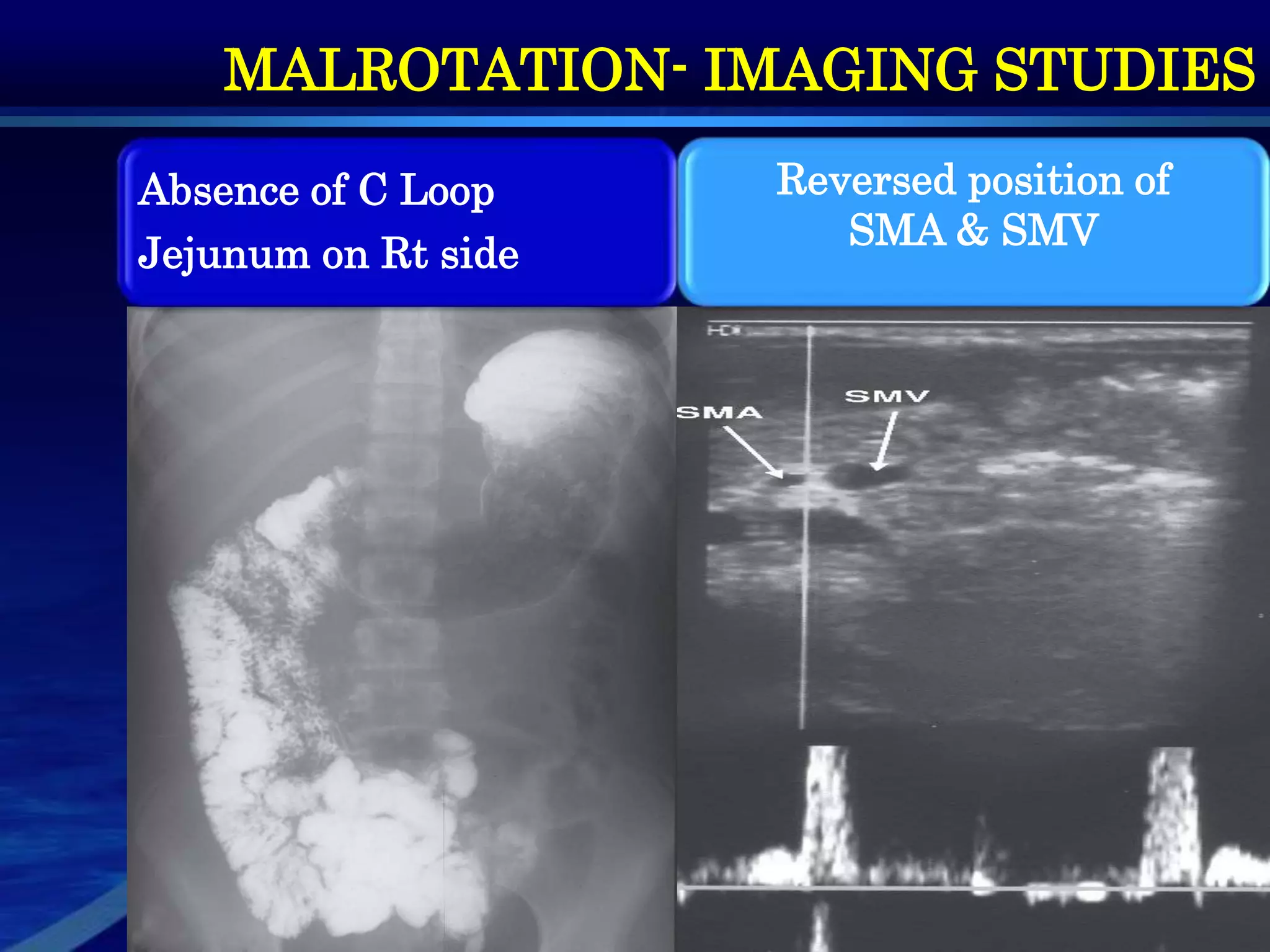 Neonatal Bilious Vomiting- part1 | PPTX
