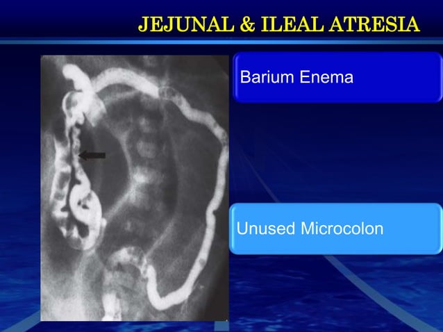 Neonatal Bilious Vomiting- part1 | PPTX | Pregnancy | Reproductive Health