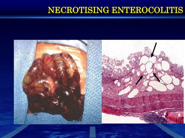 Neonatal Bilious Vomiting- part1 | PPTX | Pregnancy | Reproductive Health