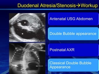 Neonatal Bilious Vomiting- part1 | PPTX