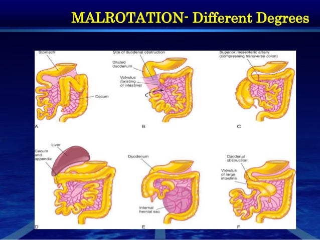 Neonatal Bilious Vomiting- part1