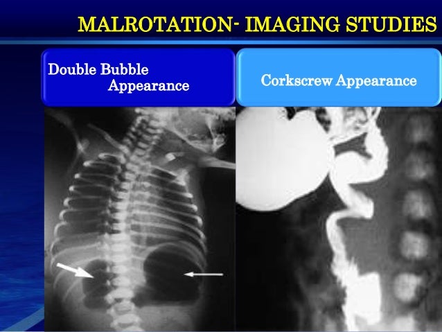 Neonatal Bilious Vomiting- part1