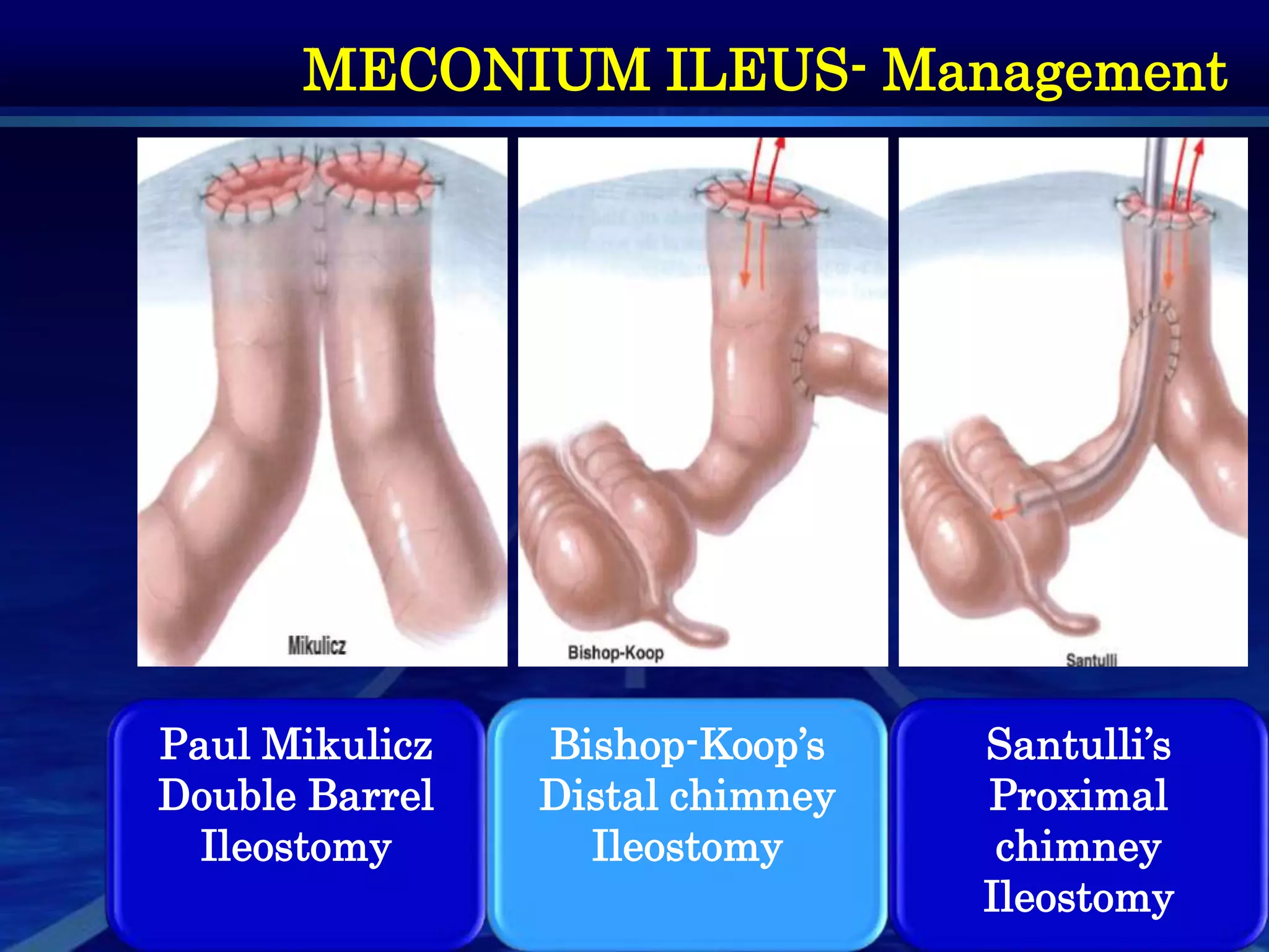 Neonatal Bilious Vomiting- Part2 | PPTX