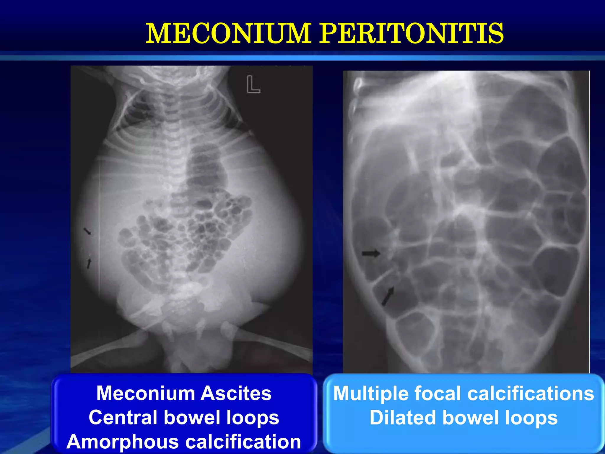 Neonatal Bilious Vomiting- Part2 | PPTX