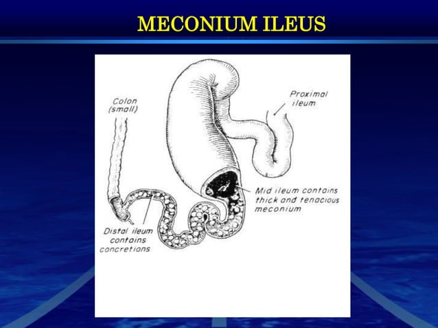 Neonatal Bilious Vomiting- Part2 | PPTX