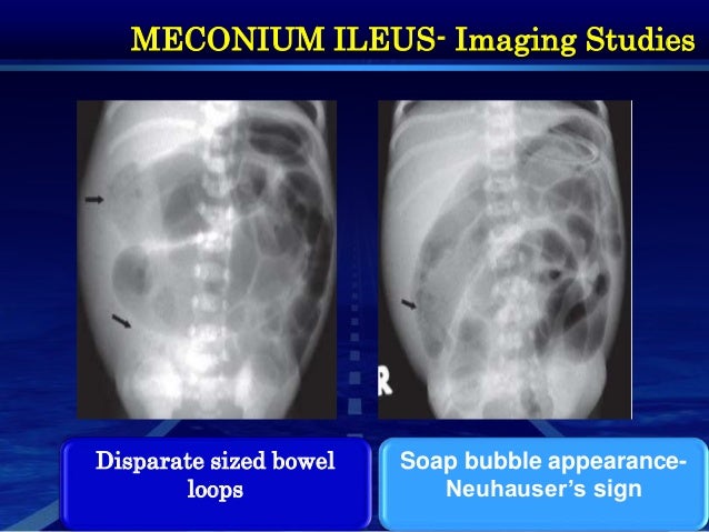 Neonatal Bilious Vomiting- Part2
