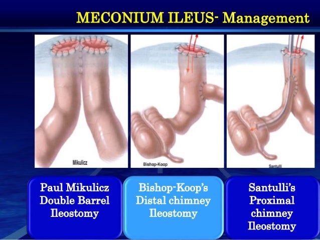 Neonatal Bilious Vomiting- Part2
