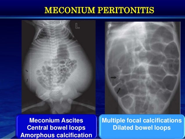 Neonatal Bilious Vomiting- Part2