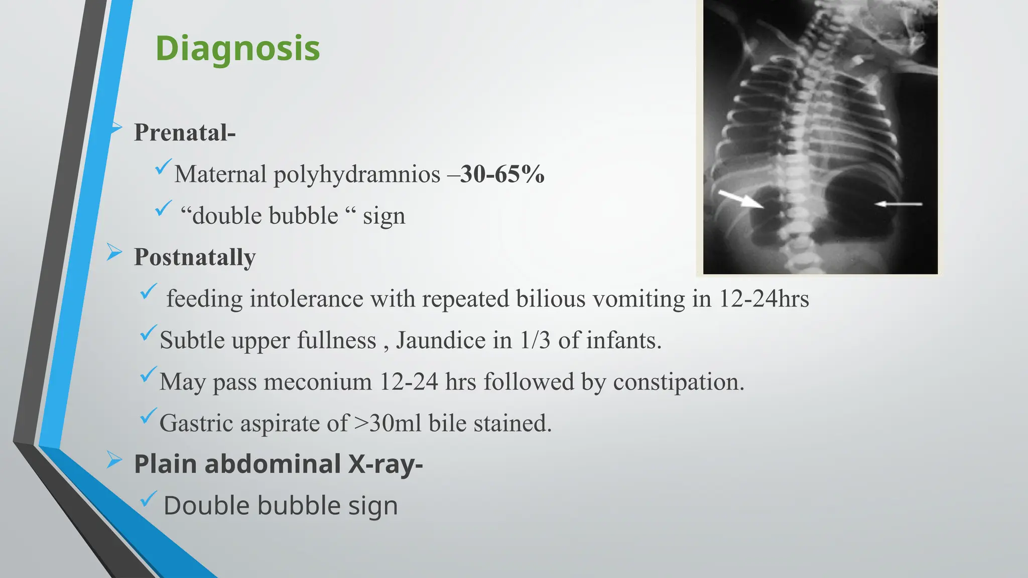 Neonatal Bilious Vomiting in neonatal period | PPTX