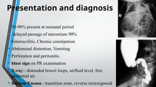 Neonatal Bilious Vomiting in neonatal period | PPTX