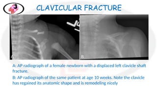 NEONATAL BIRTH FRACTURES - DESCRIBES THE FRACTURES OCCURRING DURING ...