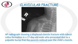 NEONATAL BIRTH FRACTURES - DESCRIBES THE FRACTURES OCCURRING DURING ...