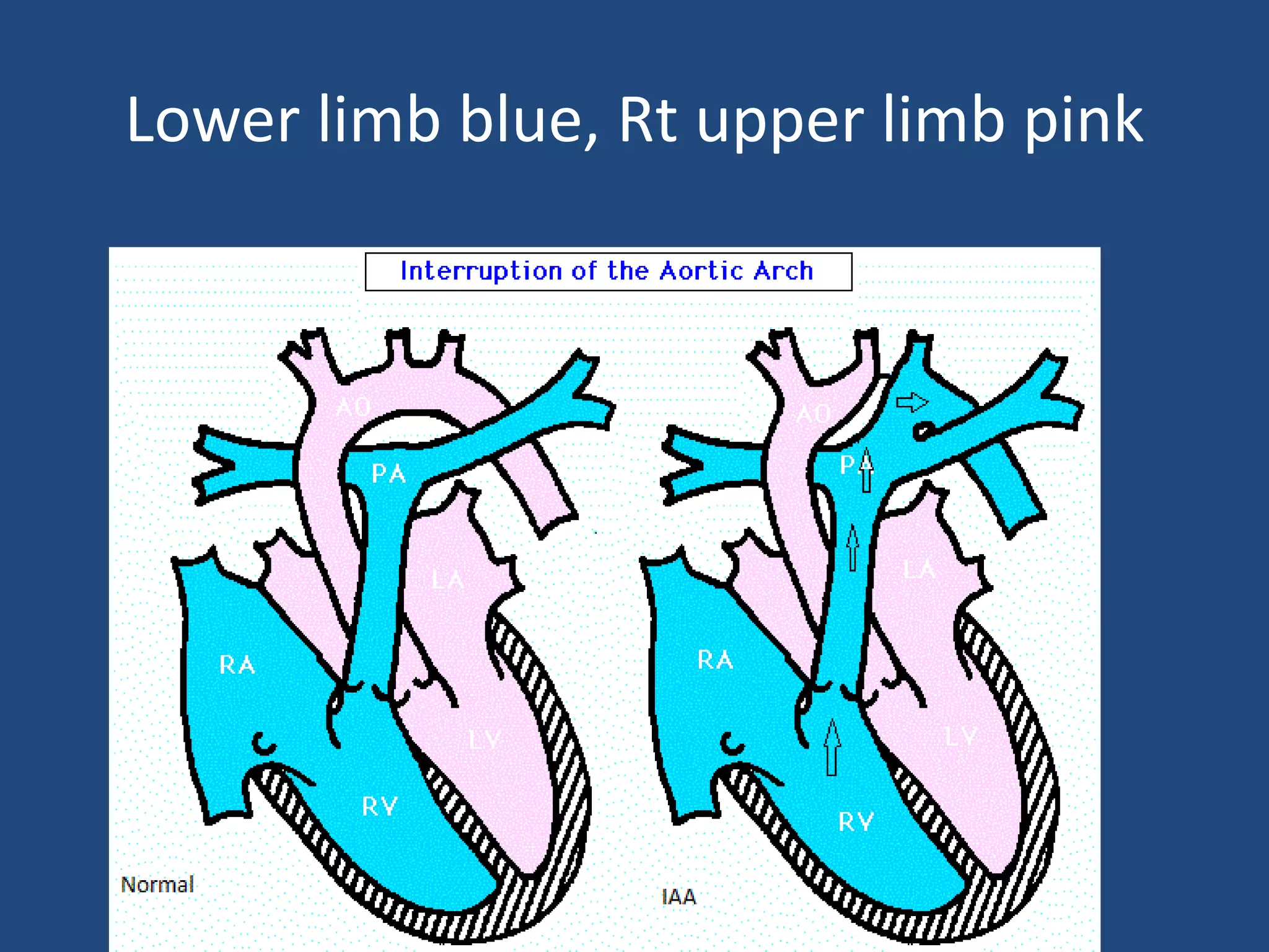 Neonatal cardiac emergency | PPTX