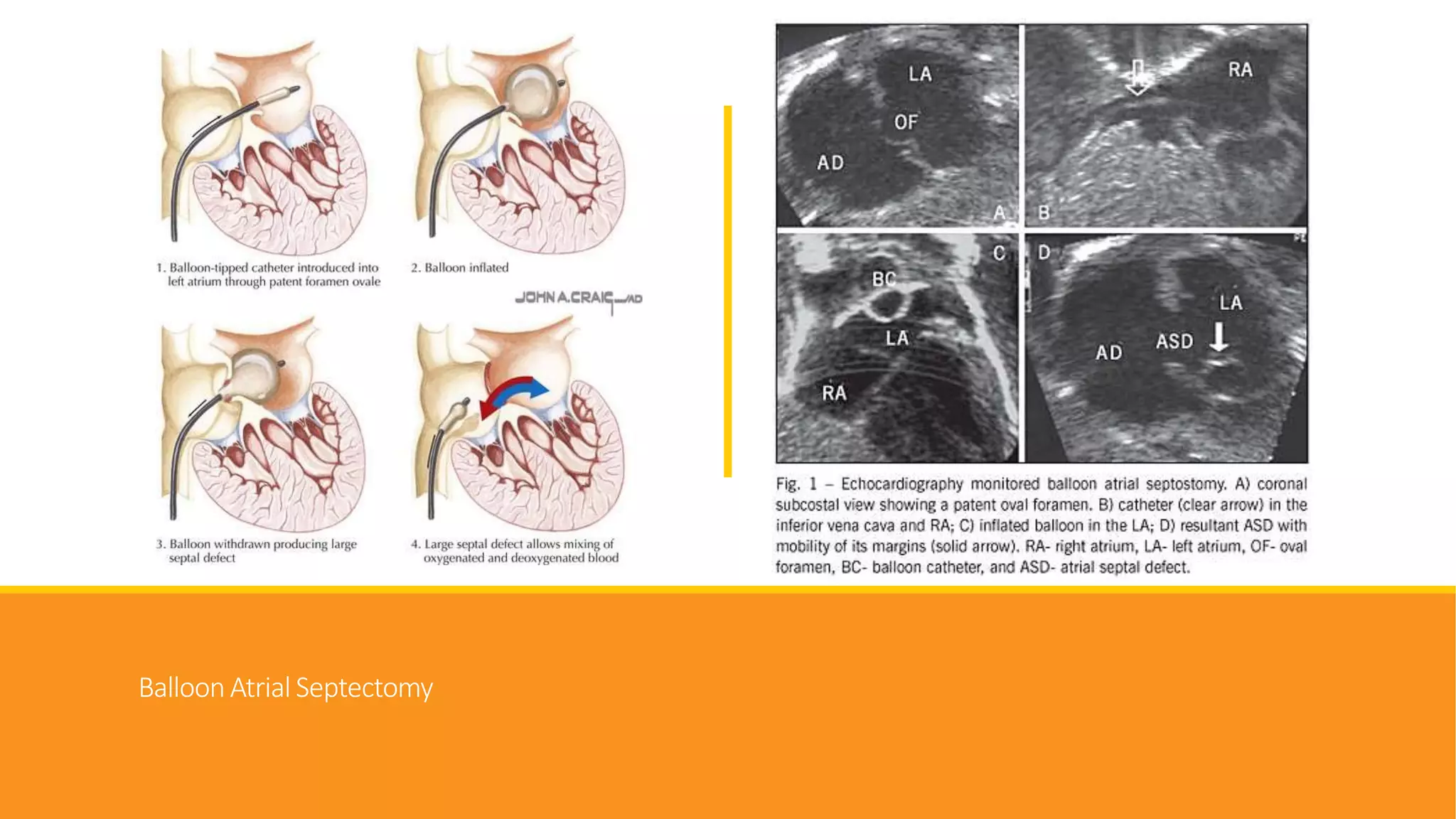 Neonatal cardiac emergency | PPTX
