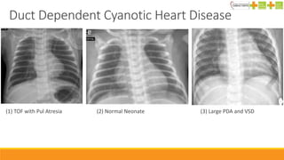 Neonatal cardiac emergency | PPTX | Heart and Cardiovascular Diseases ...