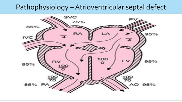 Neonatal cardiac failure | PPTX | Heart and Cardiovascular Diseases ...