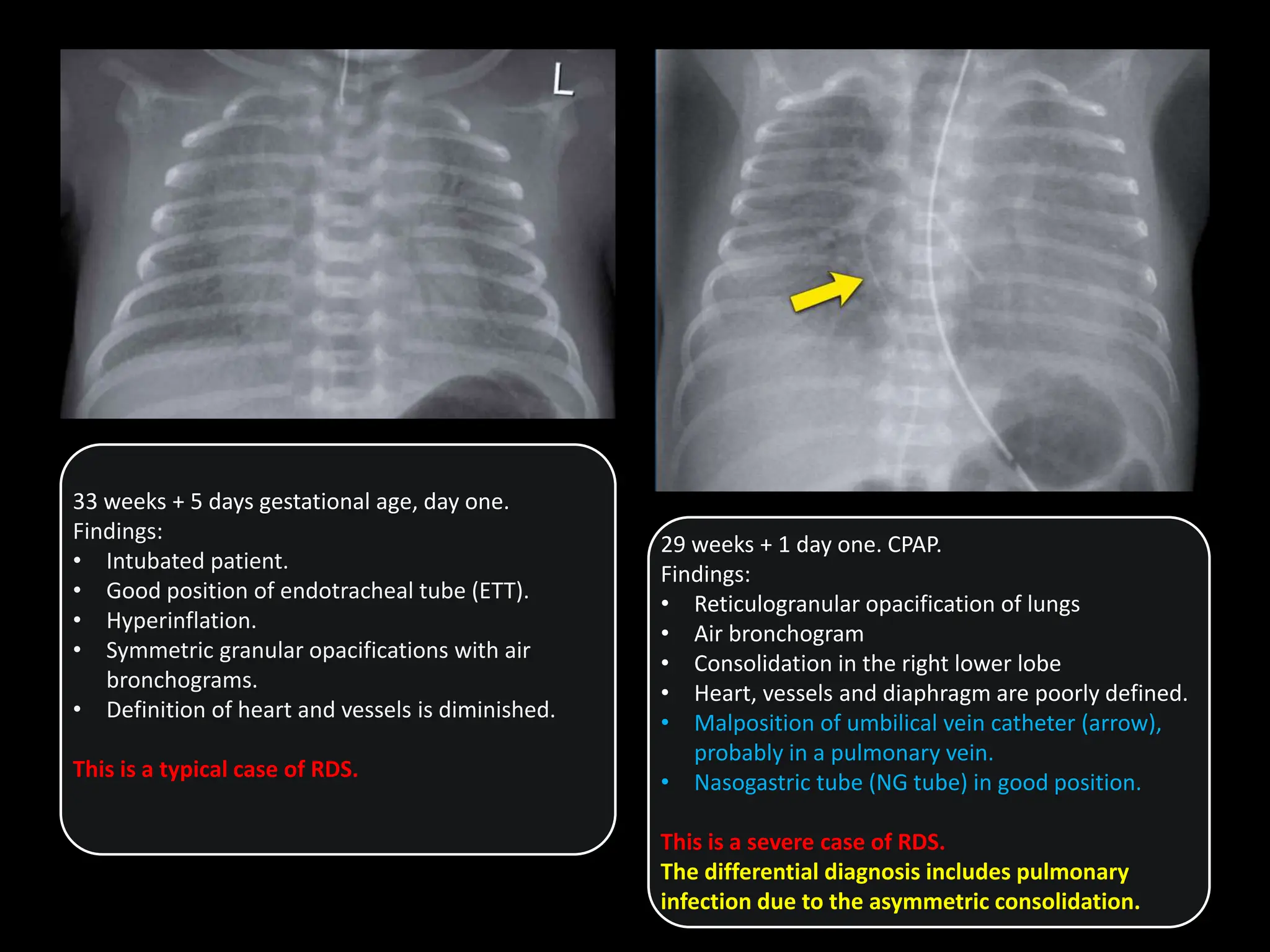 The Neonatal chest dr.xay.pptx