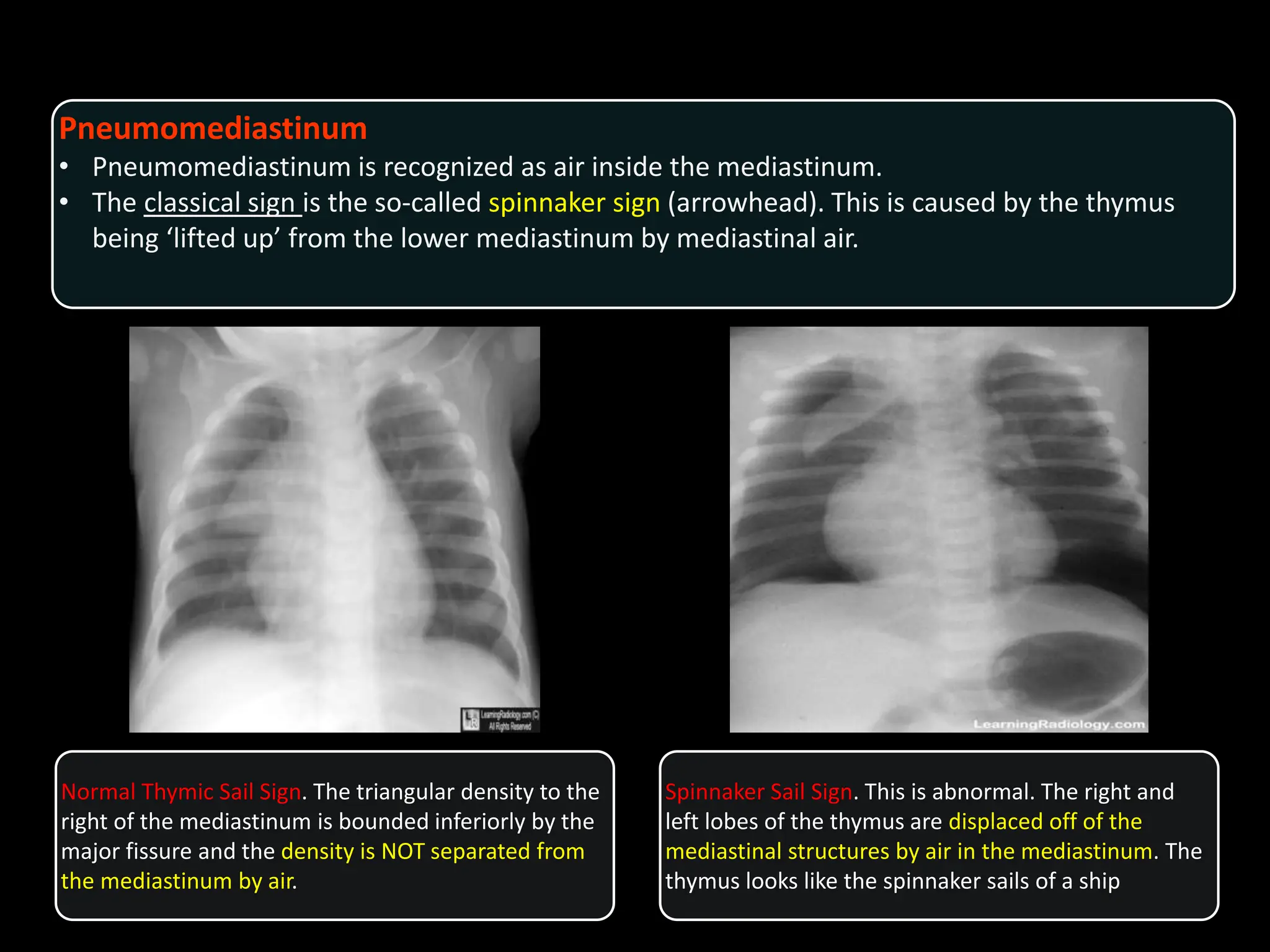 The Neonatal chest dr.xay.pptx